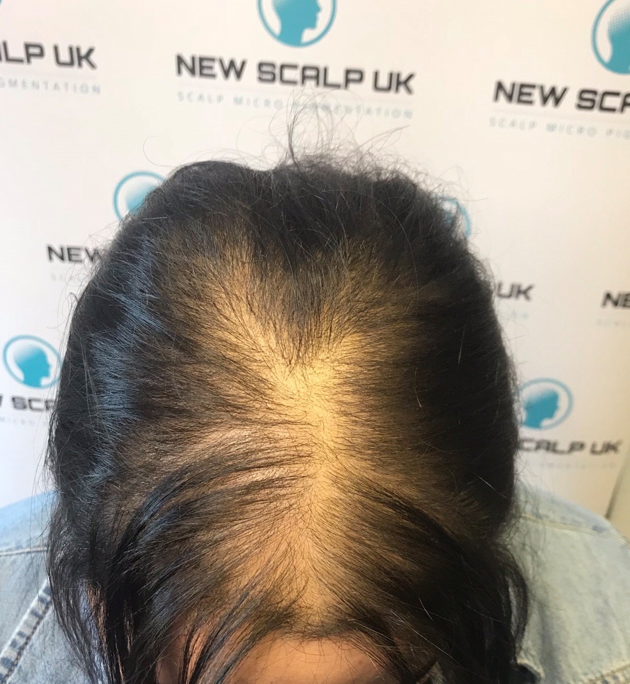 SMP For Women – New Scalp UK: SMP Treatment and Training