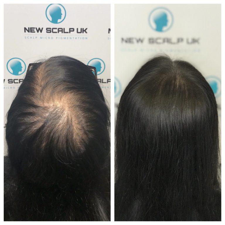 SMP For Women – New Scalp UK: SMP Treatment and Training